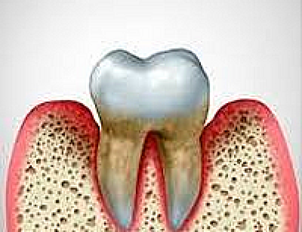 Anti-inflammatory Effects of Lactobacillus Brevis (CD2) on Periodontal ...